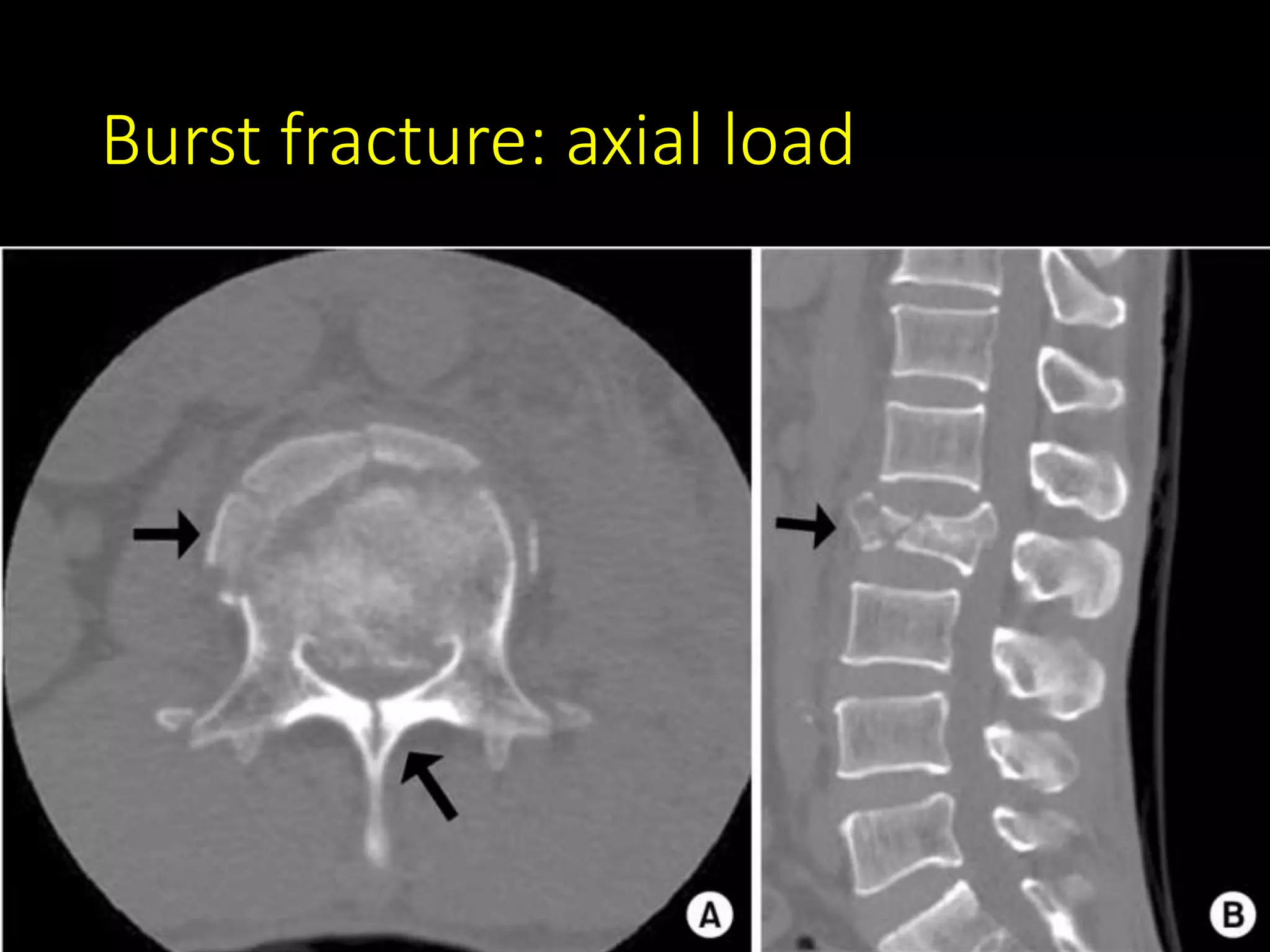 chance fractures of the spine | PPTX