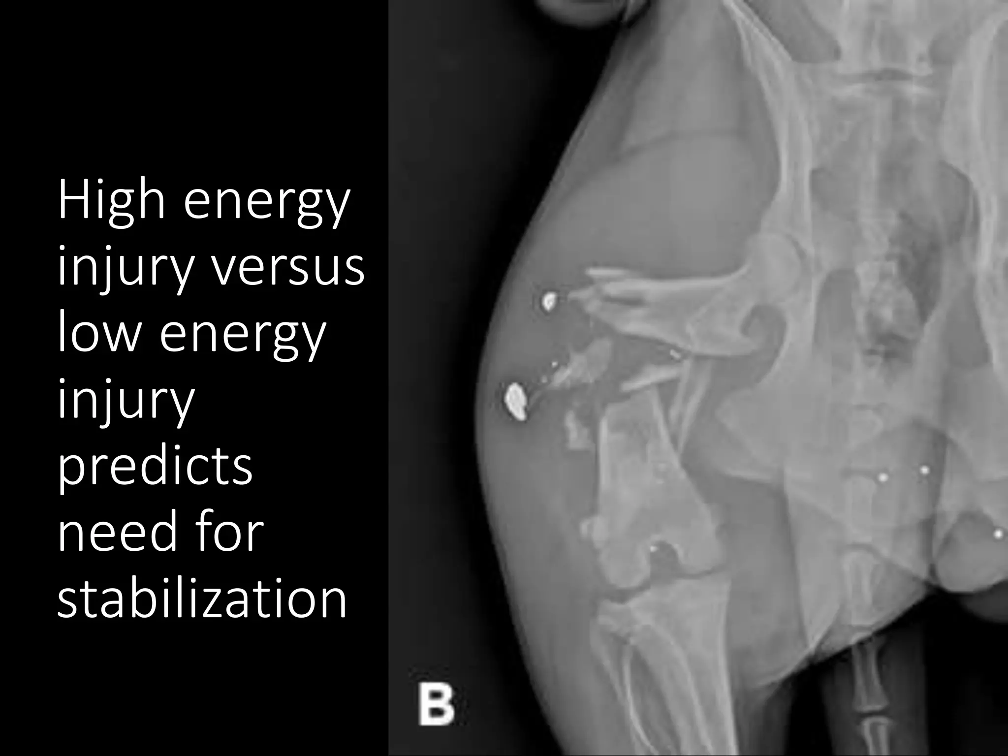 chance fractures of the spine | PPTX