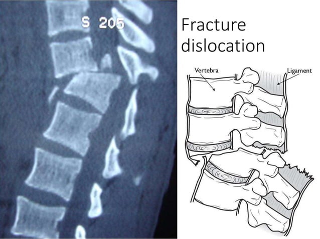 chance fractures of the spine | PPTX