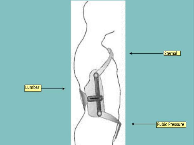 Lecture : costotransversectomy for t12 fx | PPTX
