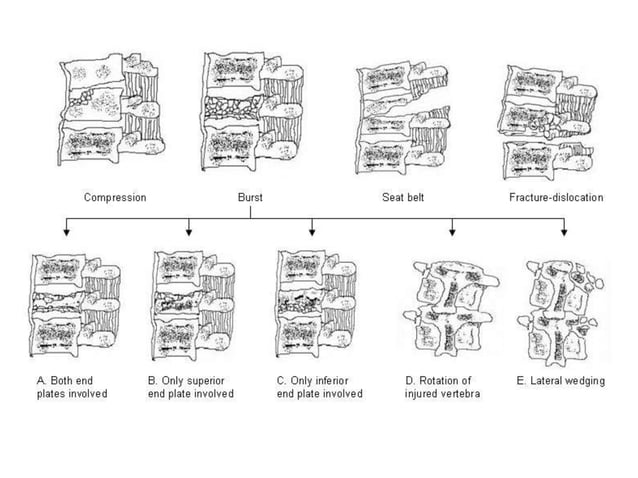 Lecture : costotransversectomy for t12 fx | PPTX