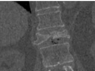 Lecture : costotransversectomy for t12 fx | PPTX
