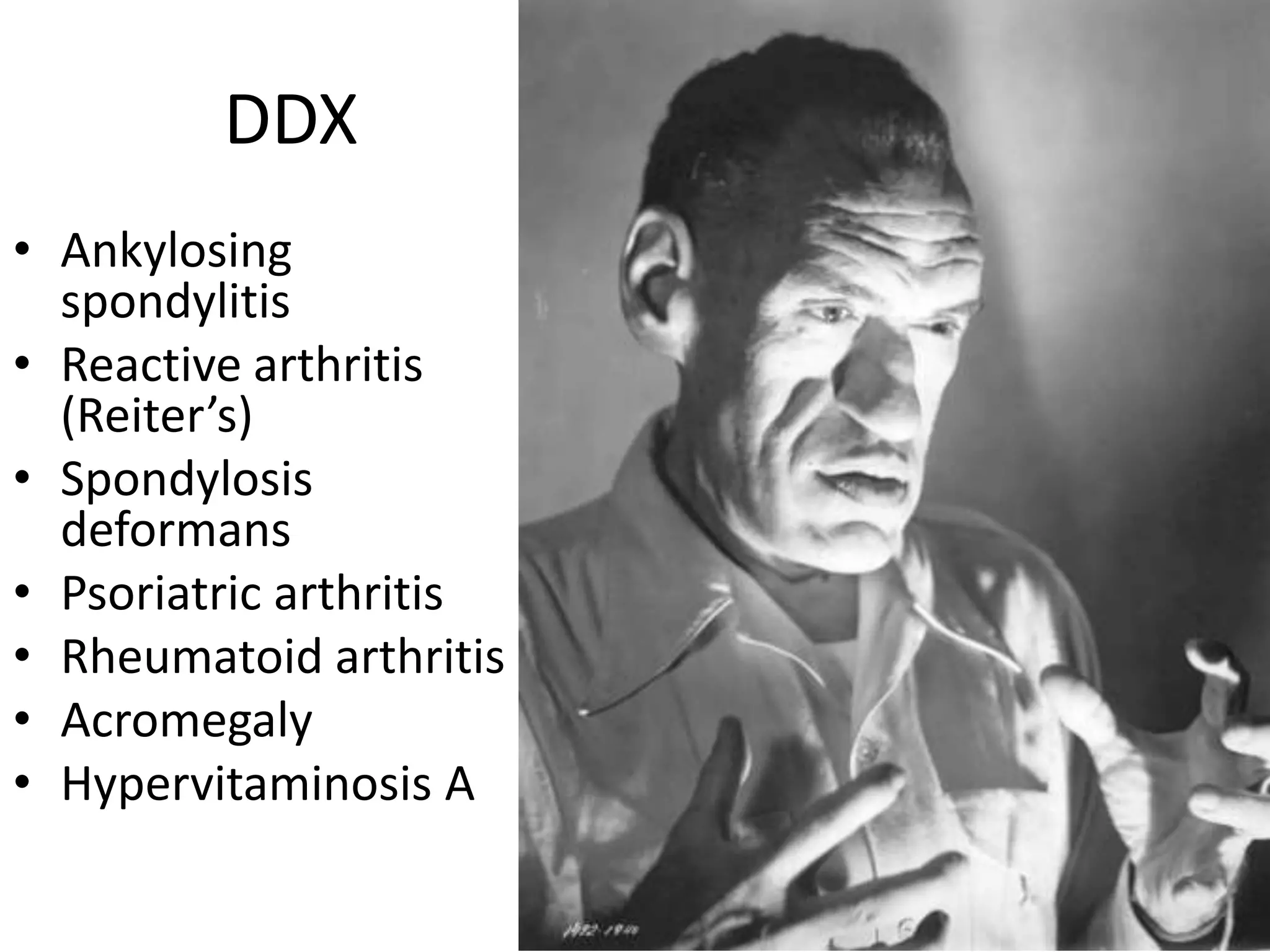 DISH: Diffuse Idiopathic Skeletal Hyperostosis of the spine | PPTX