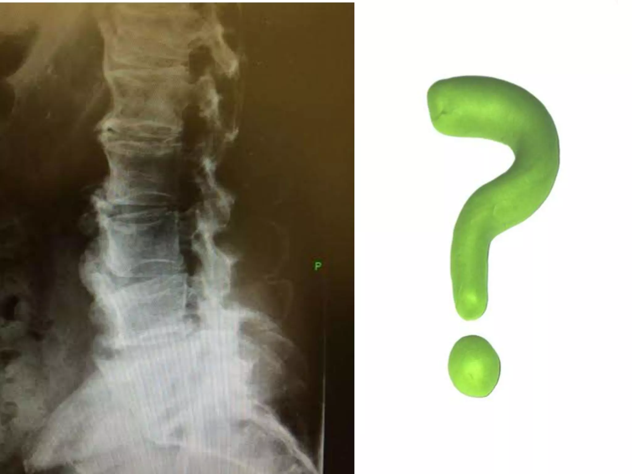 DISH: Diffuse Idiopathic Skeletal Hyperostosis of the spine | PPTX