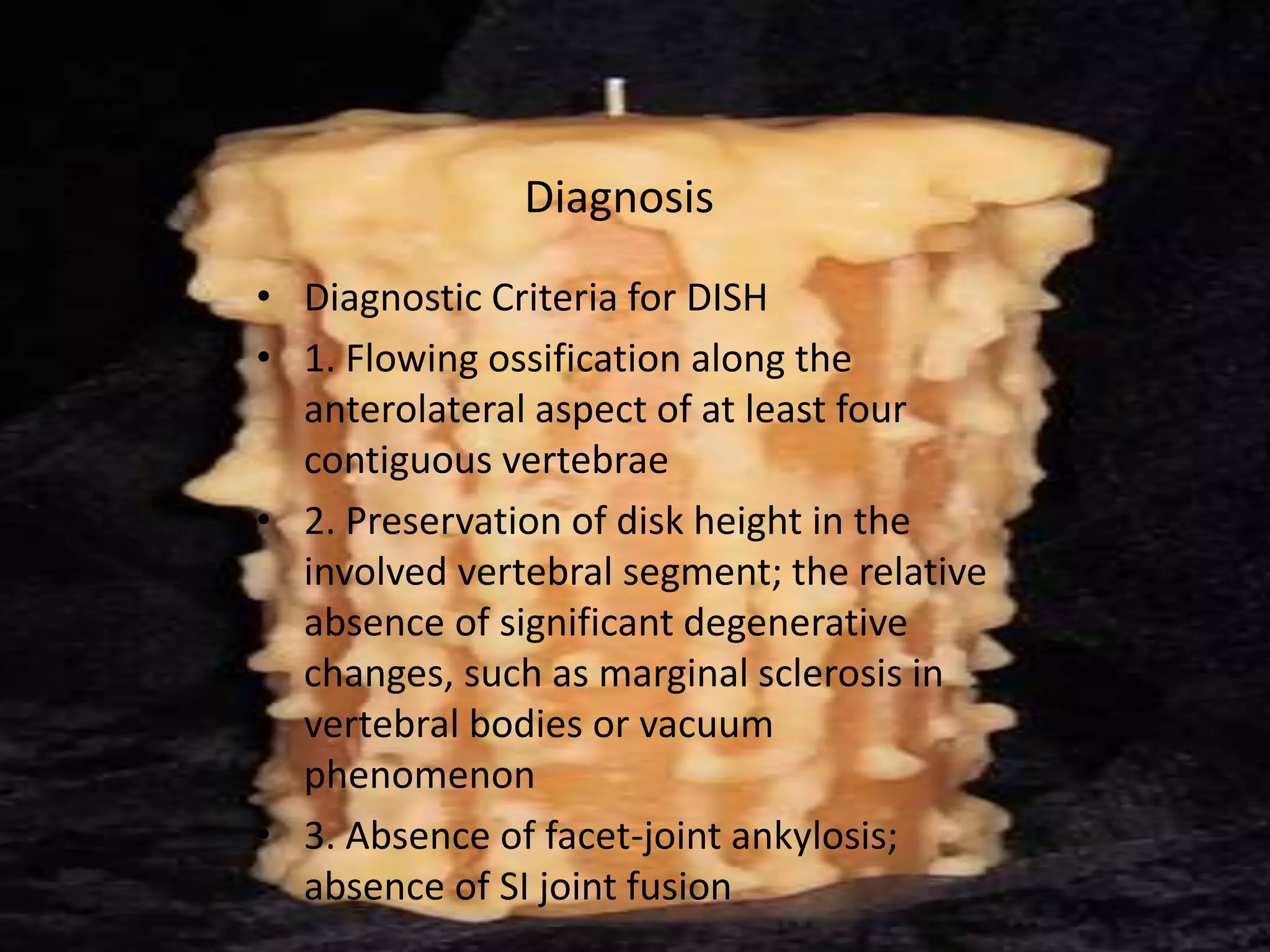 DISH: Diffuse Idiopathic Skeletal Hyperostosis of the spine | PPTX