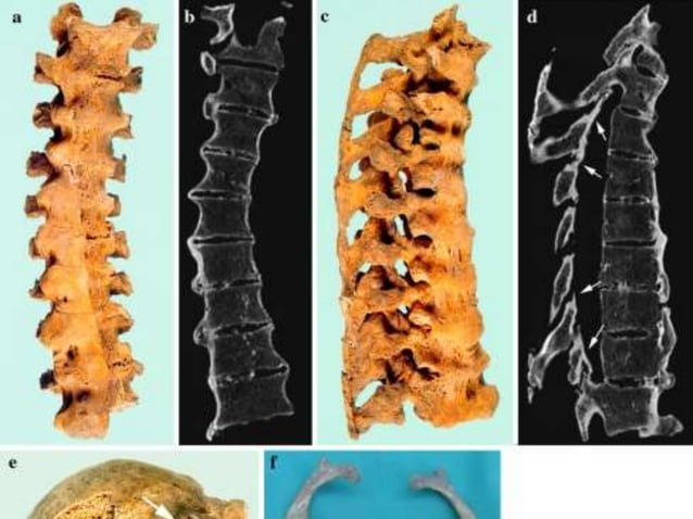 DISH: Diffuse Idiopathic Skeletal Hyperostosis of the spine | PPTX