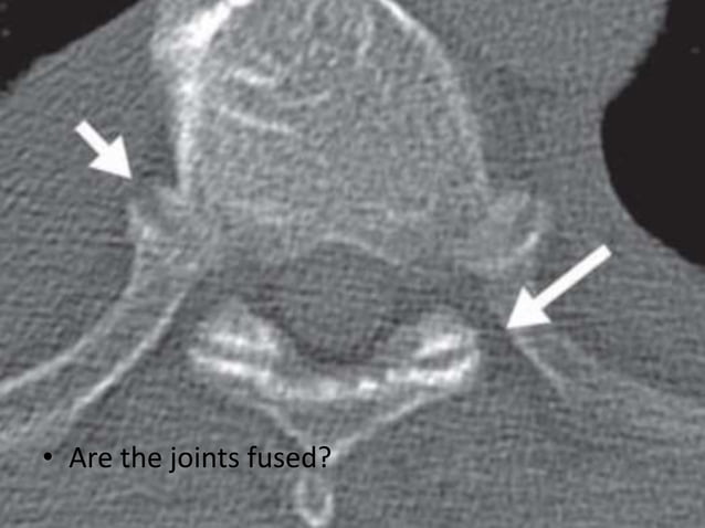 DISH: Diffuse Idiopathic Skeletal Hyperostosis of the spine | PPTX