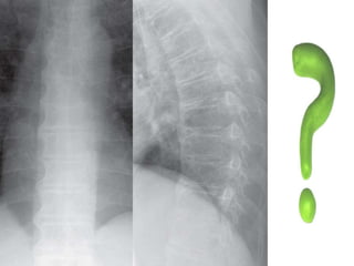 DISH: Diffuse Idiopathic Skeletal Hyperostosis of the spine | PPTX