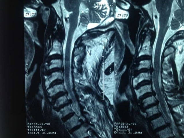 DISH: Diffuse Idiopathic Skeletal Hyperostosis of the spine | PPTX