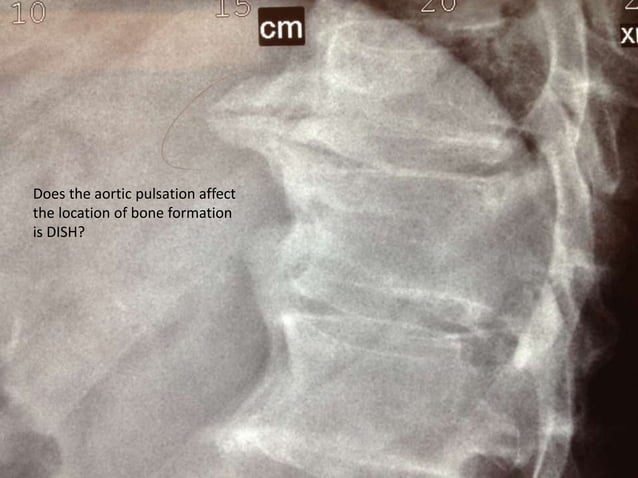 DISH: Diffuse Idiopathic Skeletal Hyperostosis of the spine | PPTX