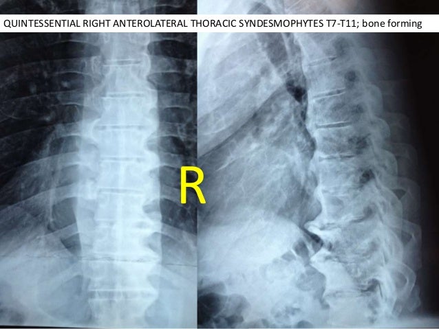 DISH: Diffuse Idiopathic Skeletal Hyperostosis of the spine