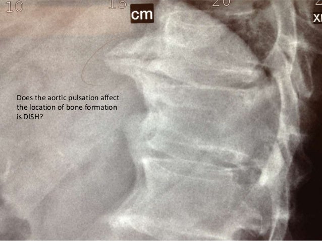 DISH: Diffuse Idiopathic Skeletal Hyperostosis of the spine