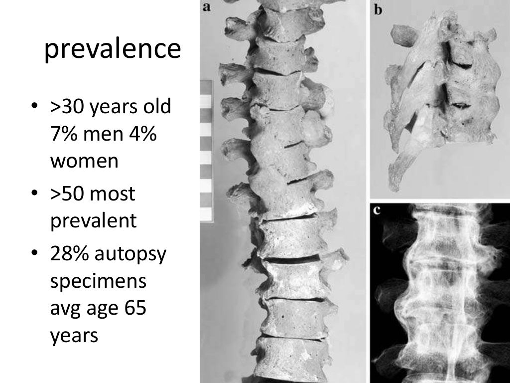 DISH: Diffuse Idiopathic Skeletal Hyperostosis of the spine