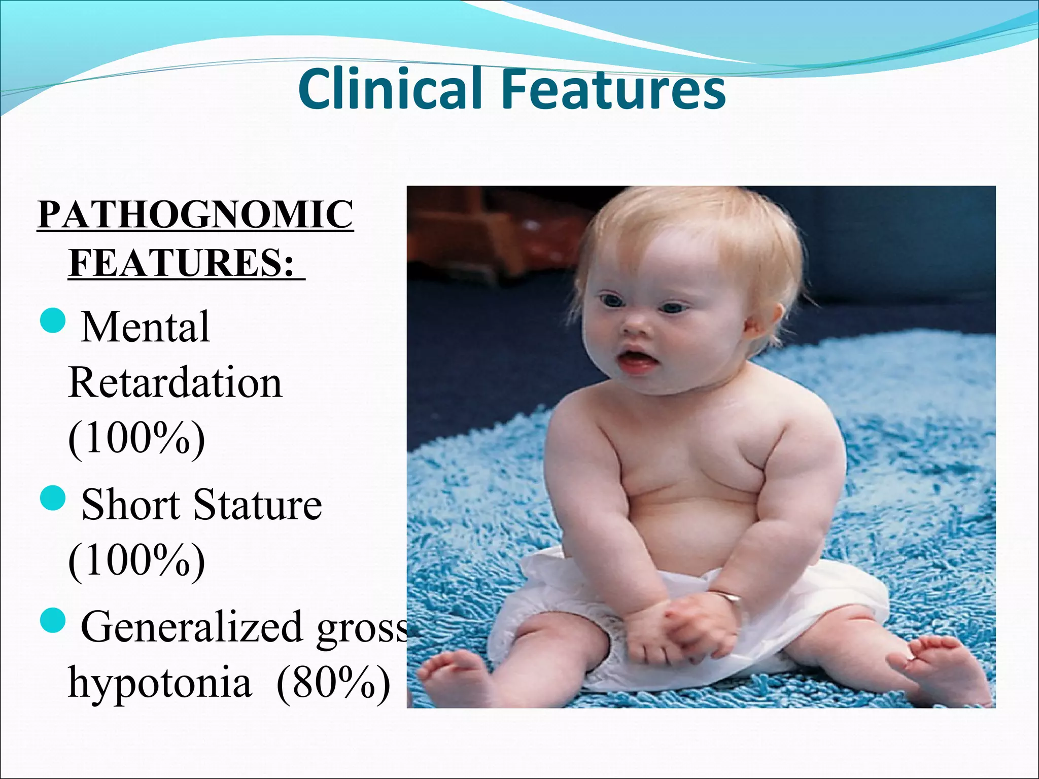 Lecture - Down Syndrome | PPT