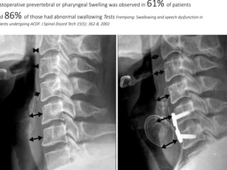 Lecture dysphagia following acdf surgery | PPTX