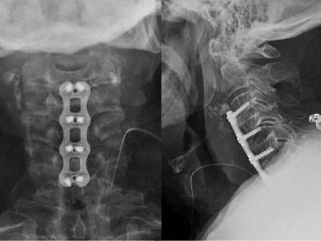 Lecture dysphagia following acdf surgery