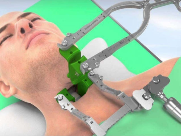 Lecture dysphagia following acdf surgery