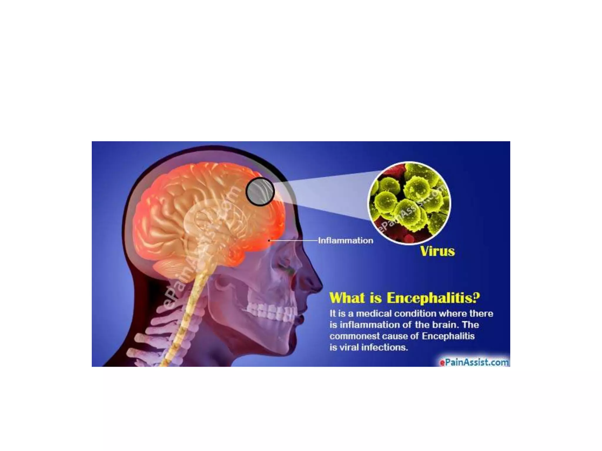 Lecture on encephalitis | PPTX