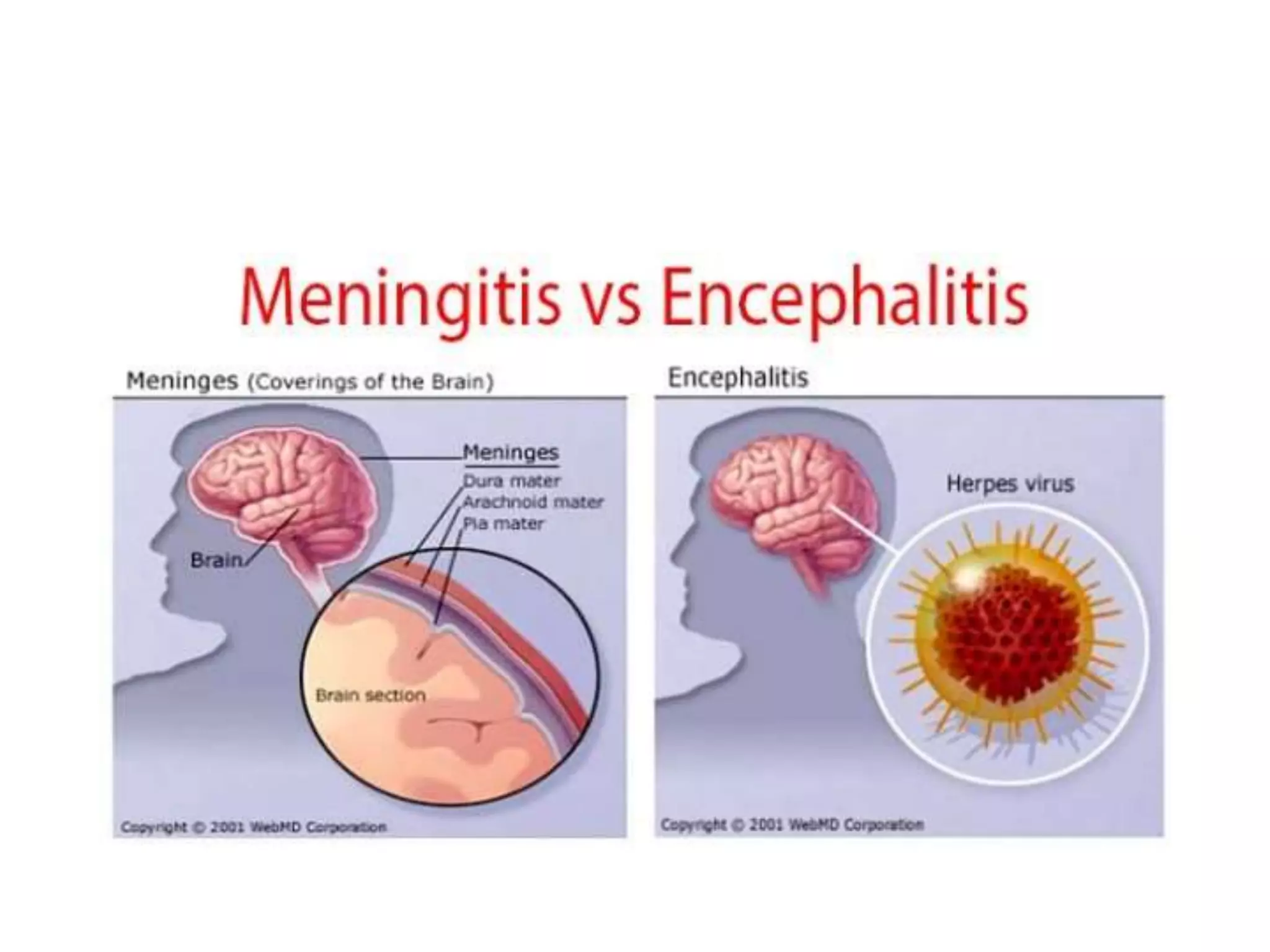 Lecture on encephalitis | PPTX