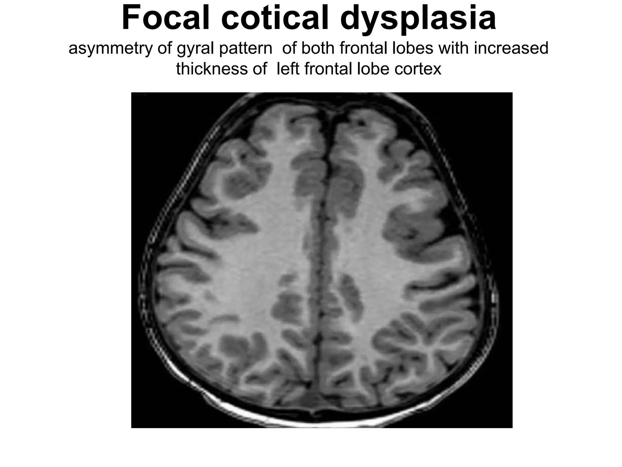 Epilepsa partial continua | PPTX