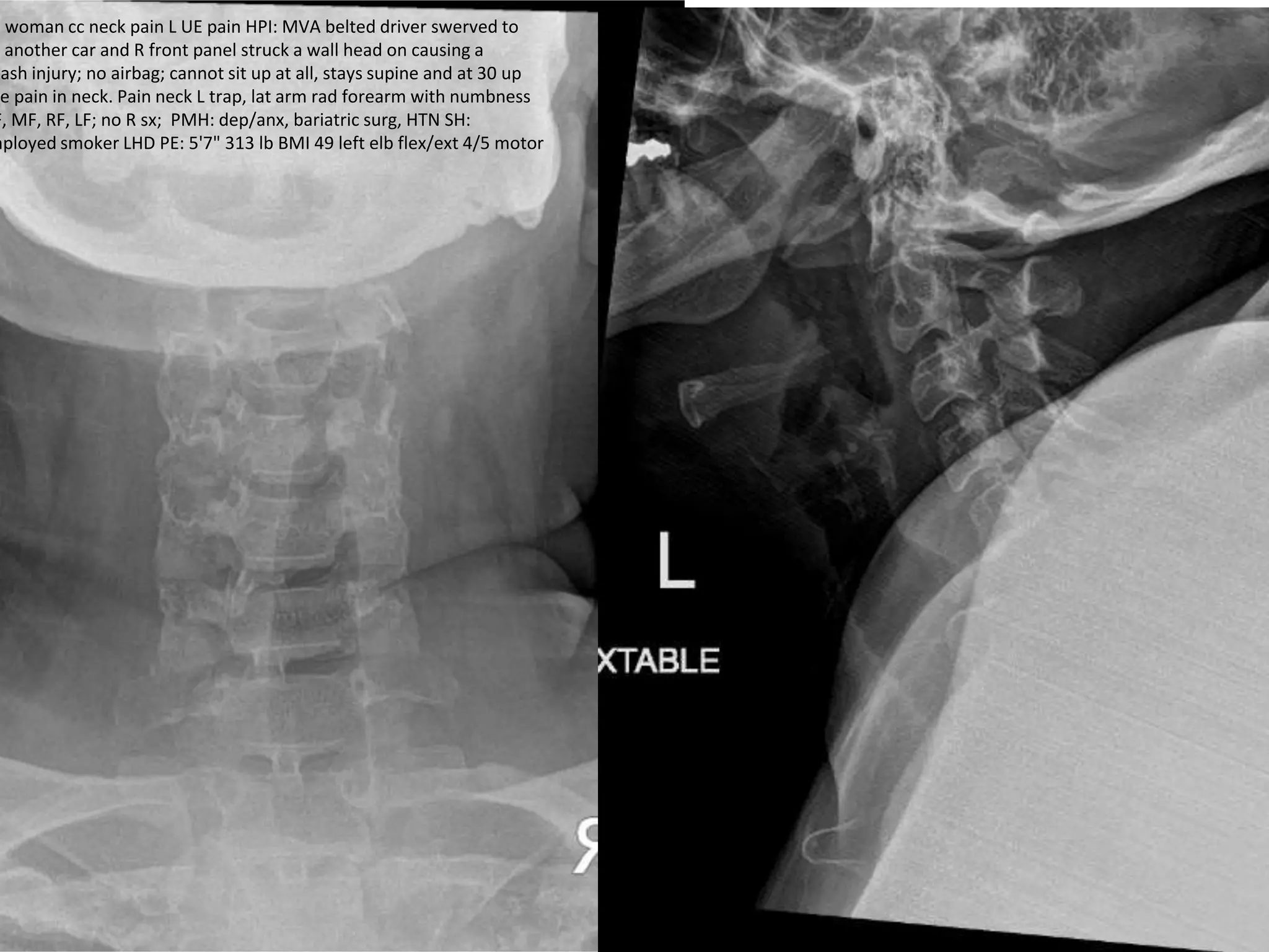 Facet injuries of the cervical spine | PPTX
