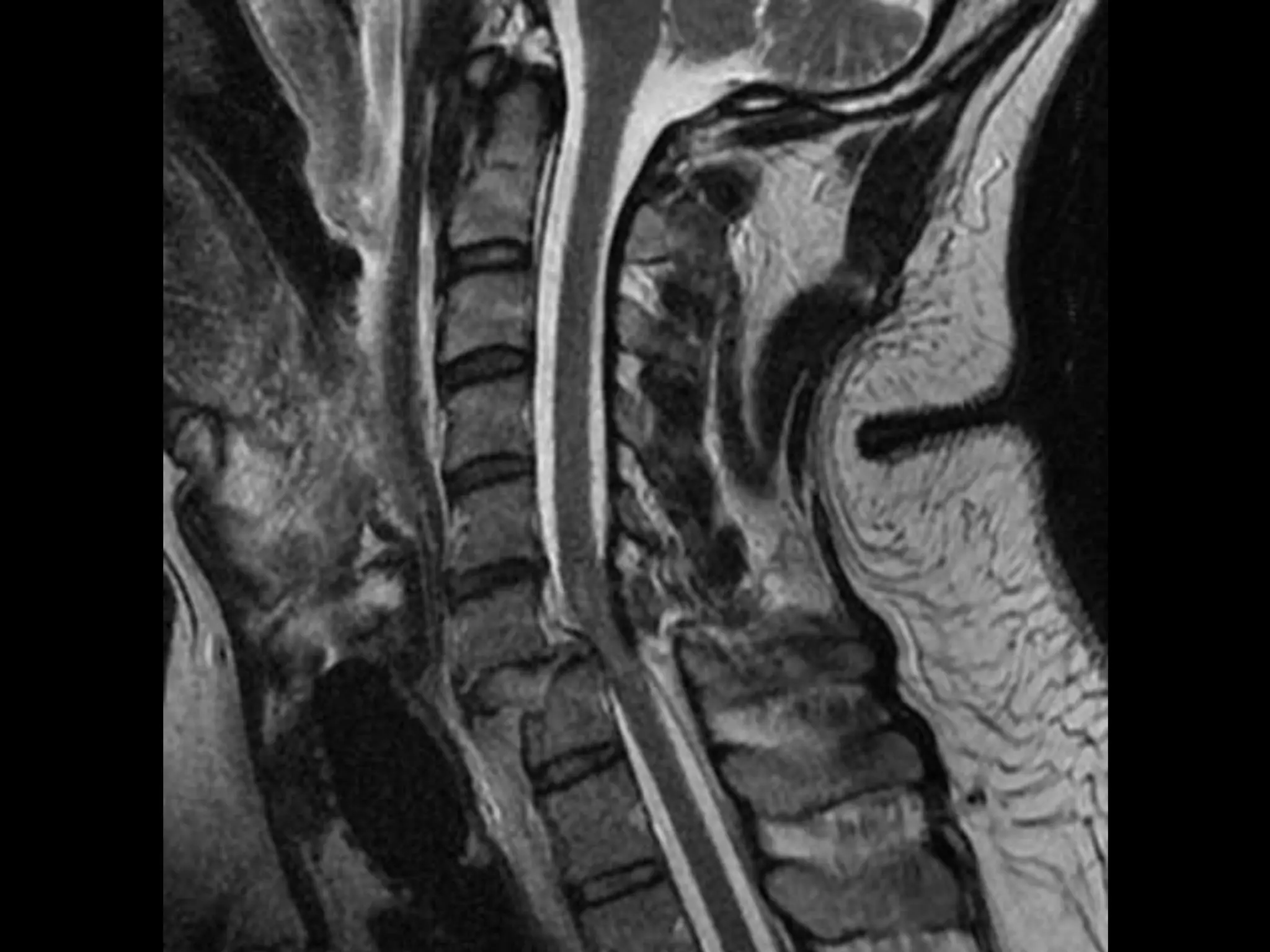 Facet injuries of the cervical spine | PPTX
