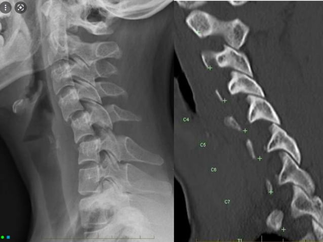 Facet injuries of the cervical spine | PPTX