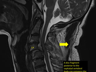 Facet injuries of the cervical spine | PPTX