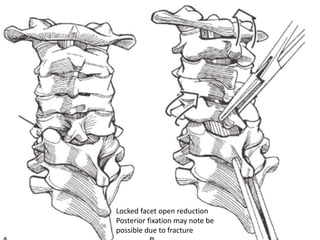 Facet injuries of the cervical spine | PPTX