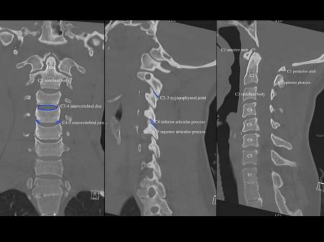 Facet injuries of the cervical spine | PPTX