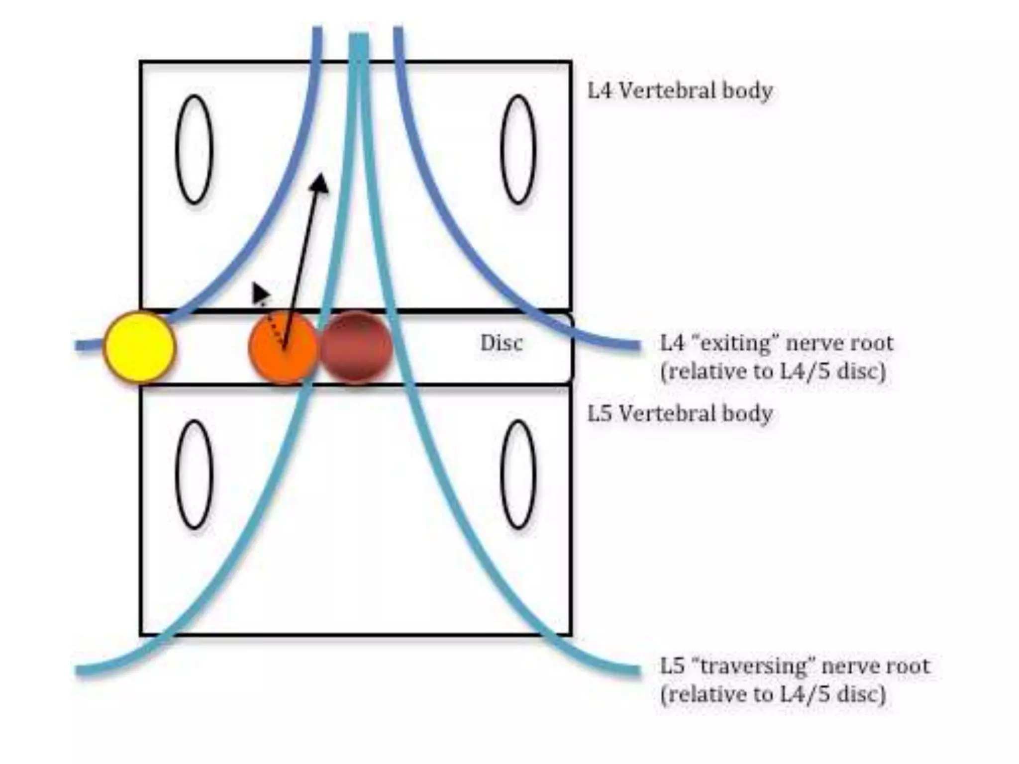 Lecture far lateral disc herniations | PPTX