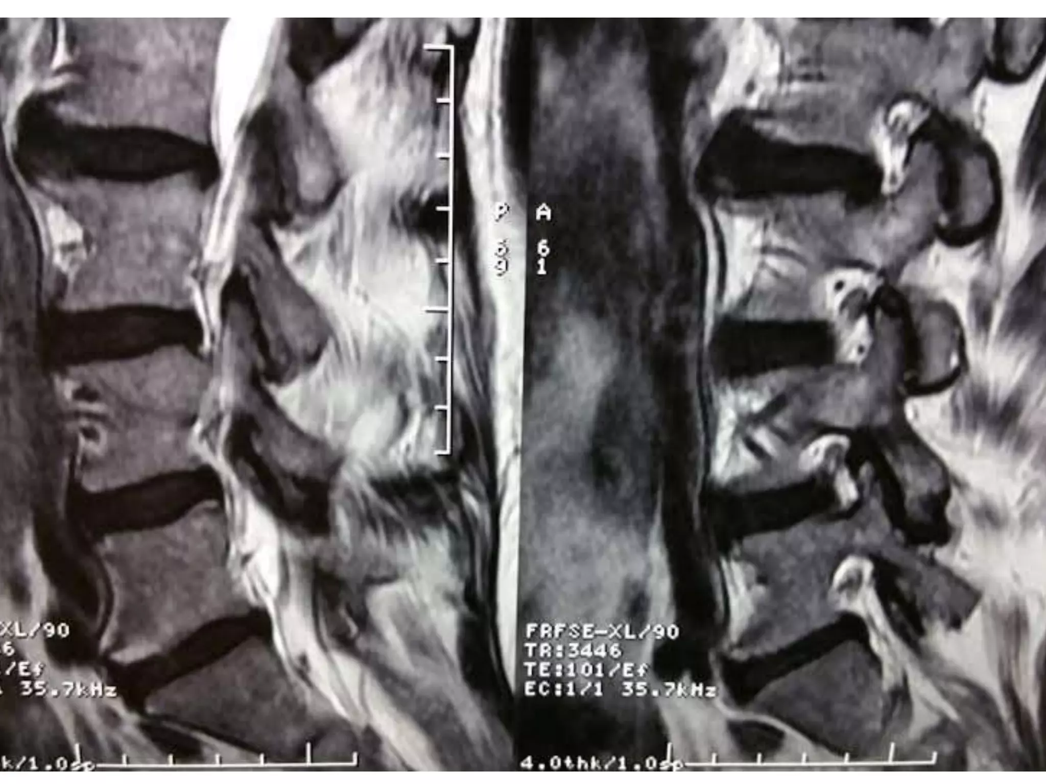 Lecture far lateral disc herniations | PPTX
