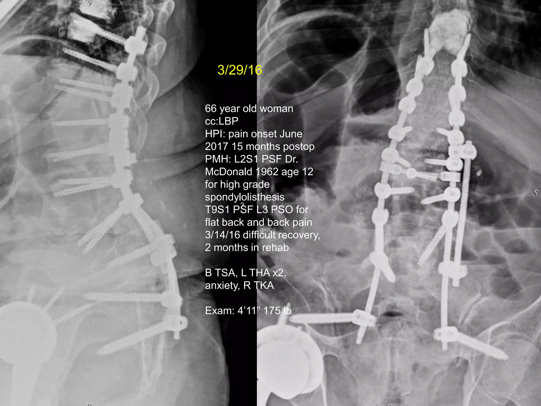 Nonunion PSO pedicle subtraction osteotomy | PPTX