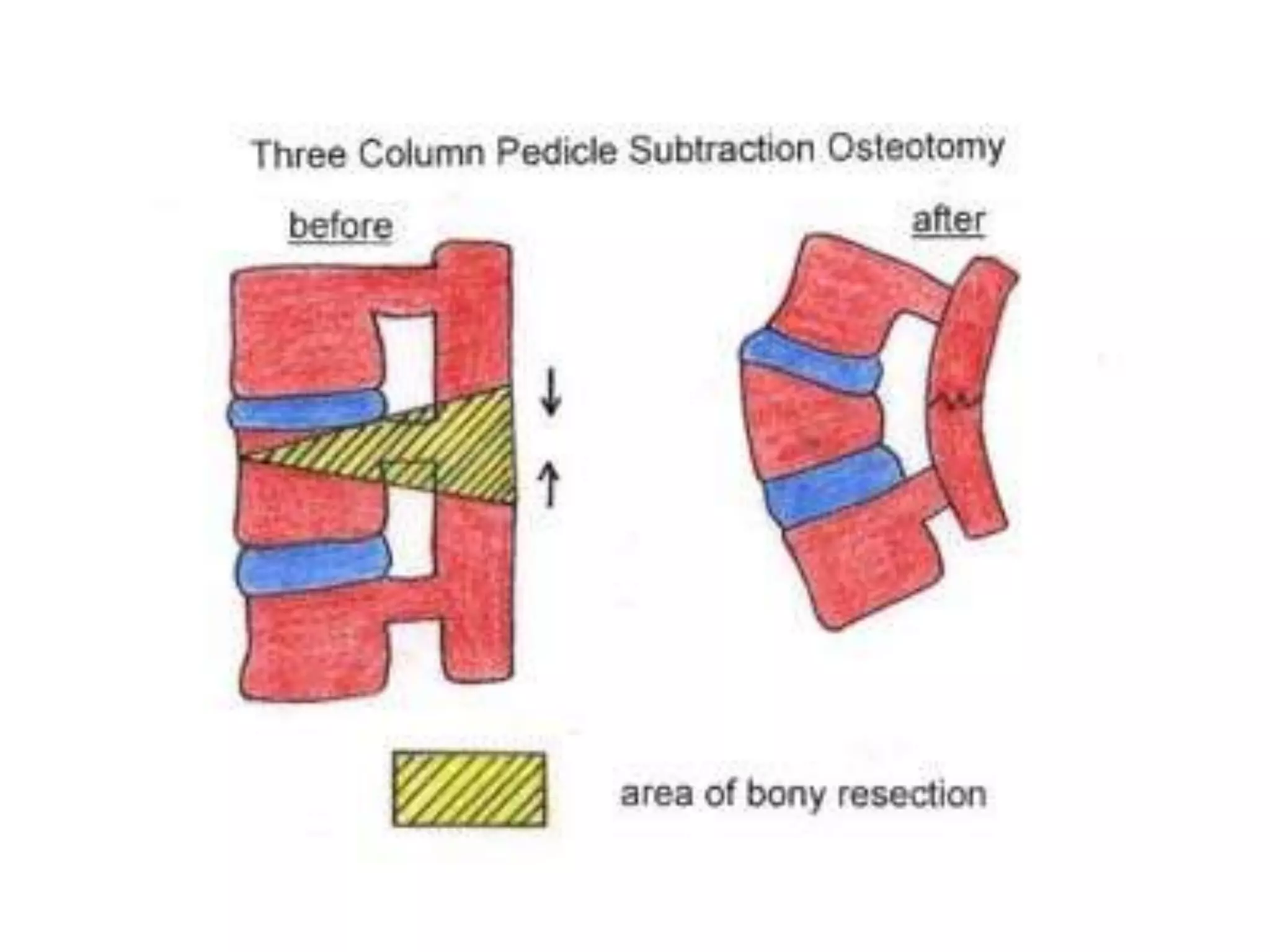Nonunion PSO pedicle subtraction osteotomy | PPTX