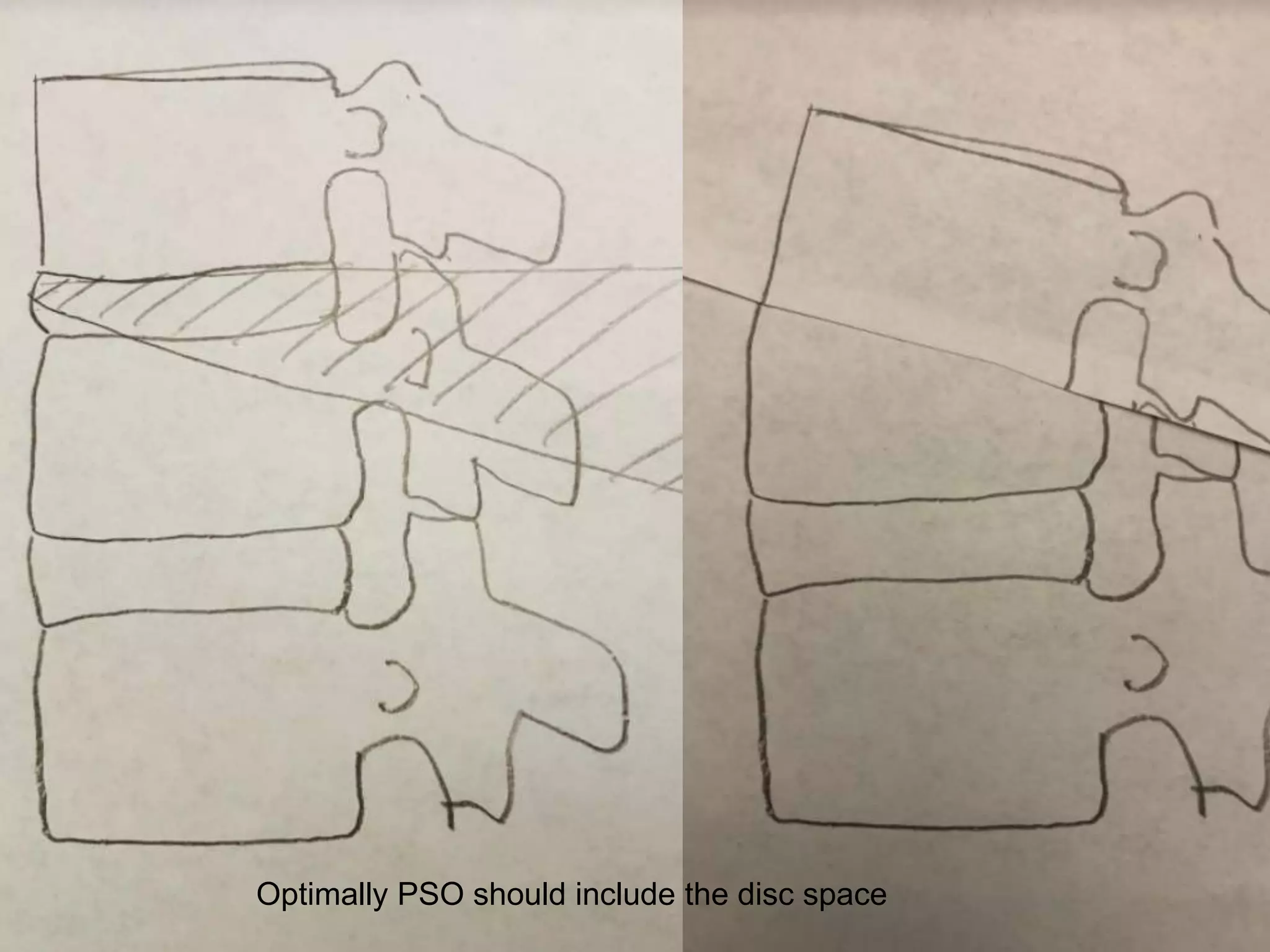 Nonunion PSO pedicle subtraction osteotomy | PPTX