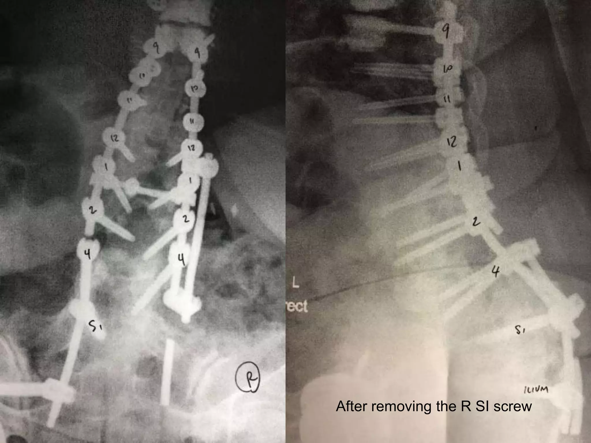 Nonunion PSO pedicle subtraction osteotomy | PPTX