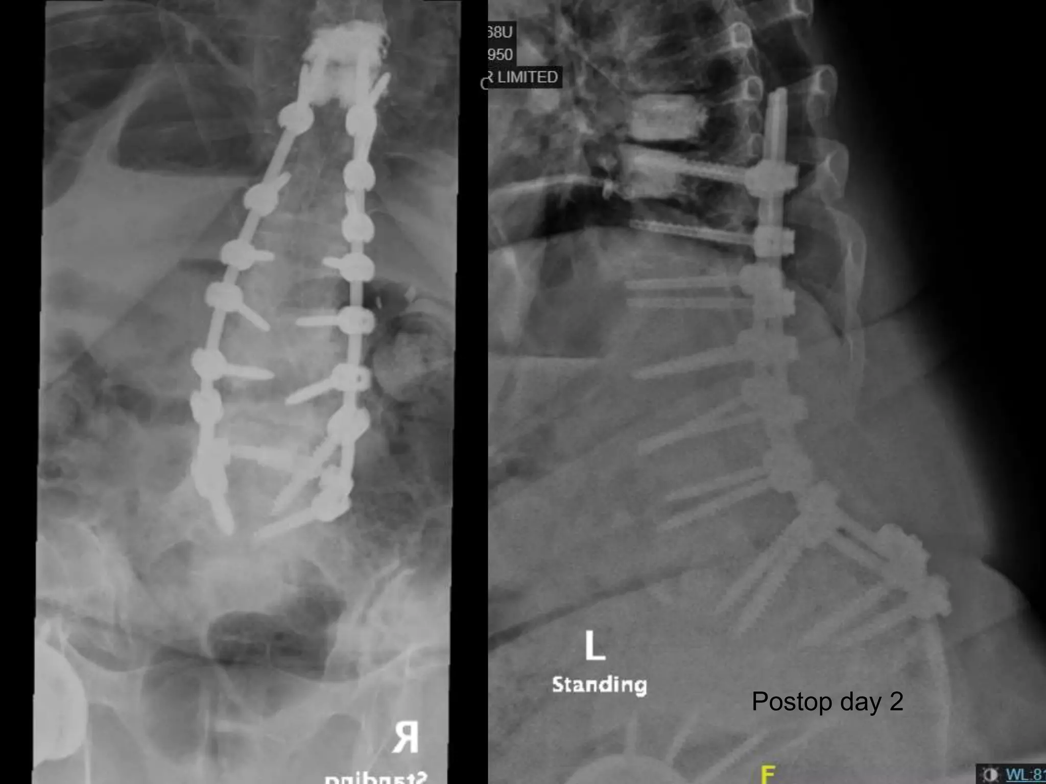 Nonunion PSO pedicle subtraction osteotomy | PPTX