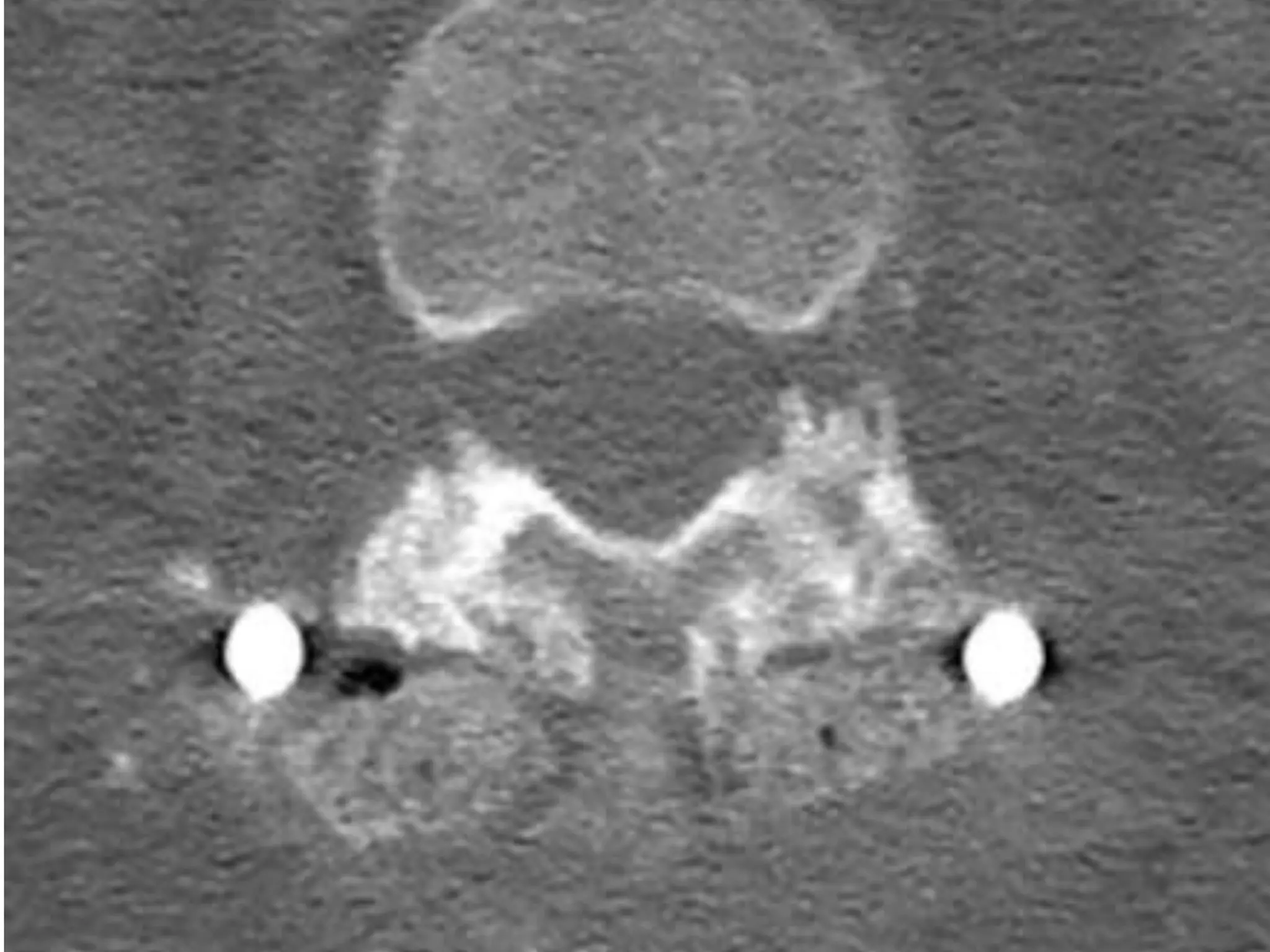 Nonunion PSO pedicle subtraction osteotomy | PPTX