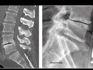 Nonunion PSO pedicle subtraction osteotomy | PPTX
