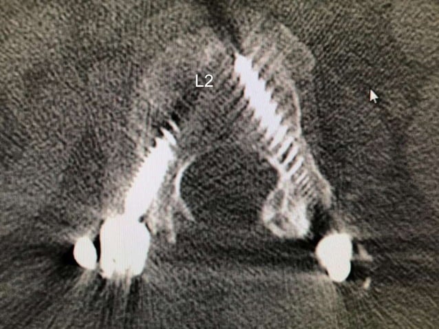 Nonunion PSO pedicle subtraction osteotomy | PPTX