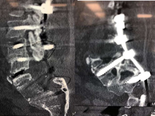 Nonunion PSO pedicle subtraction osteotomy | PPTX