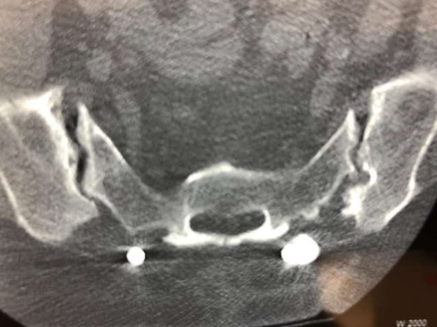 Nonunion PSO pedicle subtraction osteotomy | PPTX
