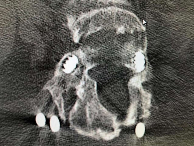 Nonunion PSO pedicle subtraction osteotomy | PPTX