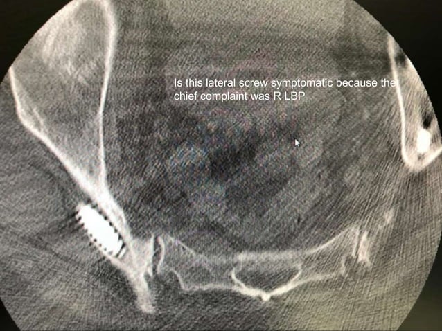 Nonunion PSO pedicle subtraction osteotomy | PPTX