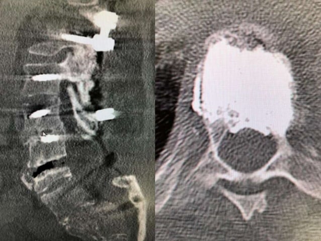 Nonunion PSO pedicle subtraction osteotomy | PPTX