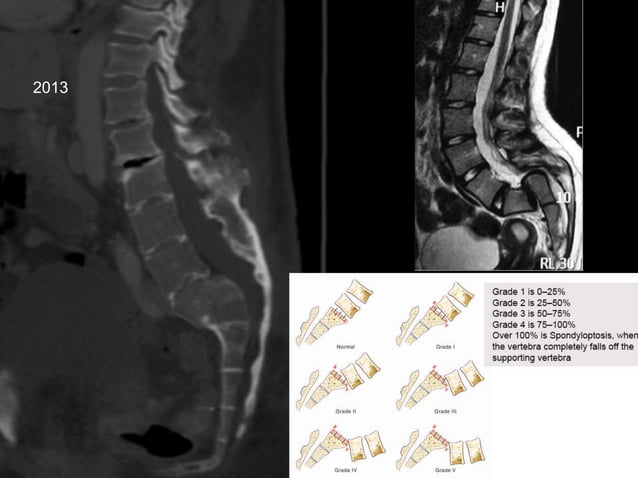 Nonunion PSO pedicle subtraction osteotomy | PPTX