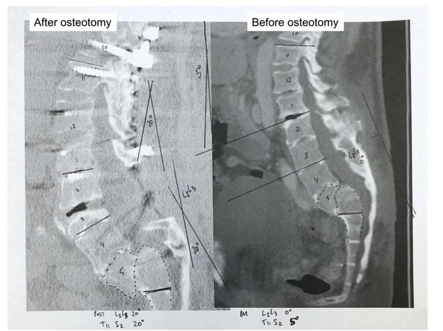 Nonunion PSO pedicle subtraction osteotomy | PPTX