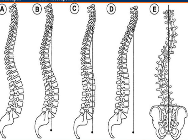 Nonunion PSO pedicle subtraction osteotomy | PPTX