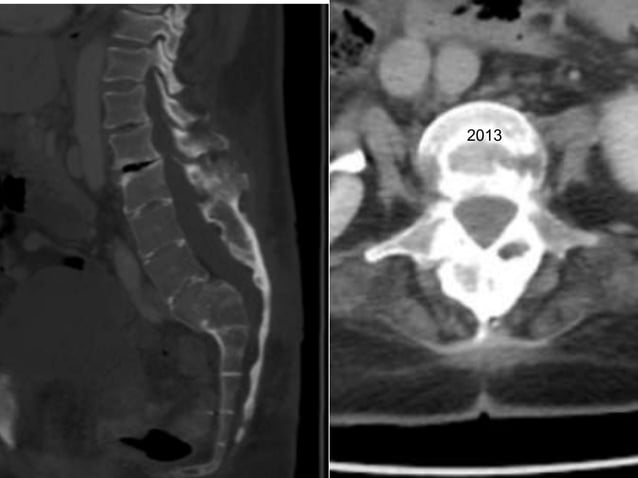 Nonunion PSO pedicle subtraction osteotomy | PPTX