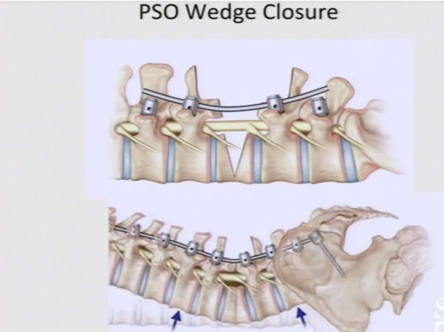 Nonunion PSO pedicle subtraction osteotomy | PPTX